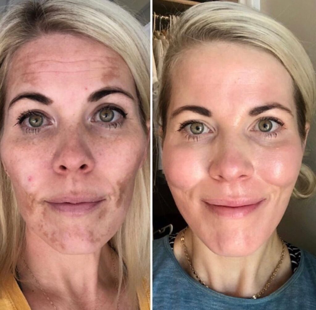 Cosmelan and Dermamelan - The Top 2 Best Depigmentation Peels